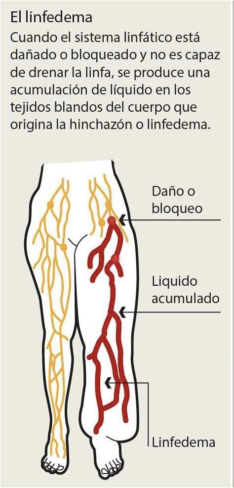 ¿Conoces acerca del linfedema? – Piel y Vida Insumos
